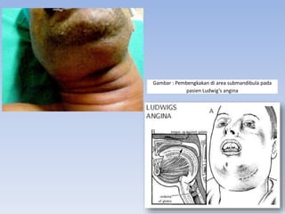 Ludwig's Angina | PPT
