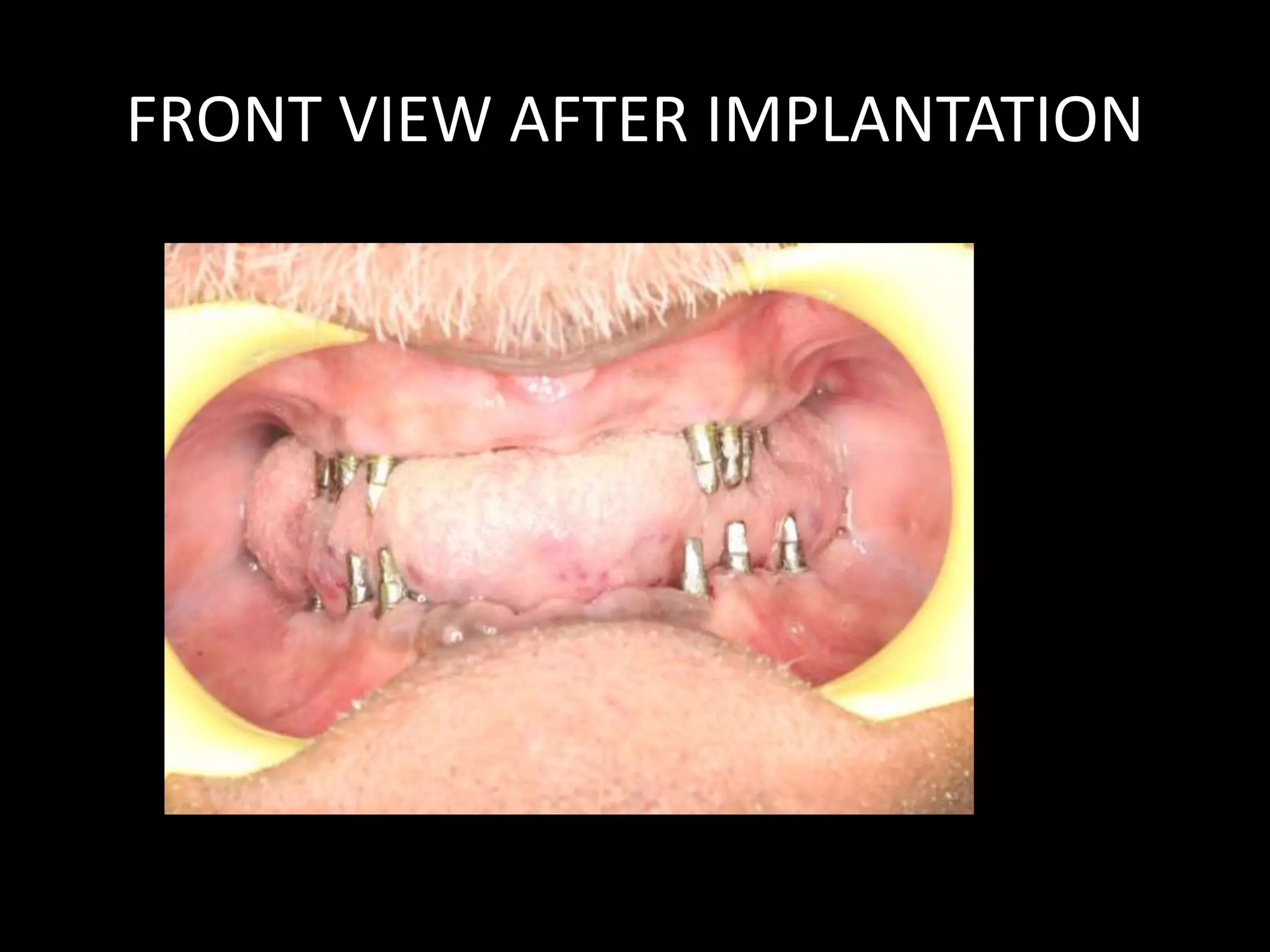 FULL MOUTH REHABILITATION WITH IMMEADIATE LOADING BASAL IMPLANTS | PPTX ...