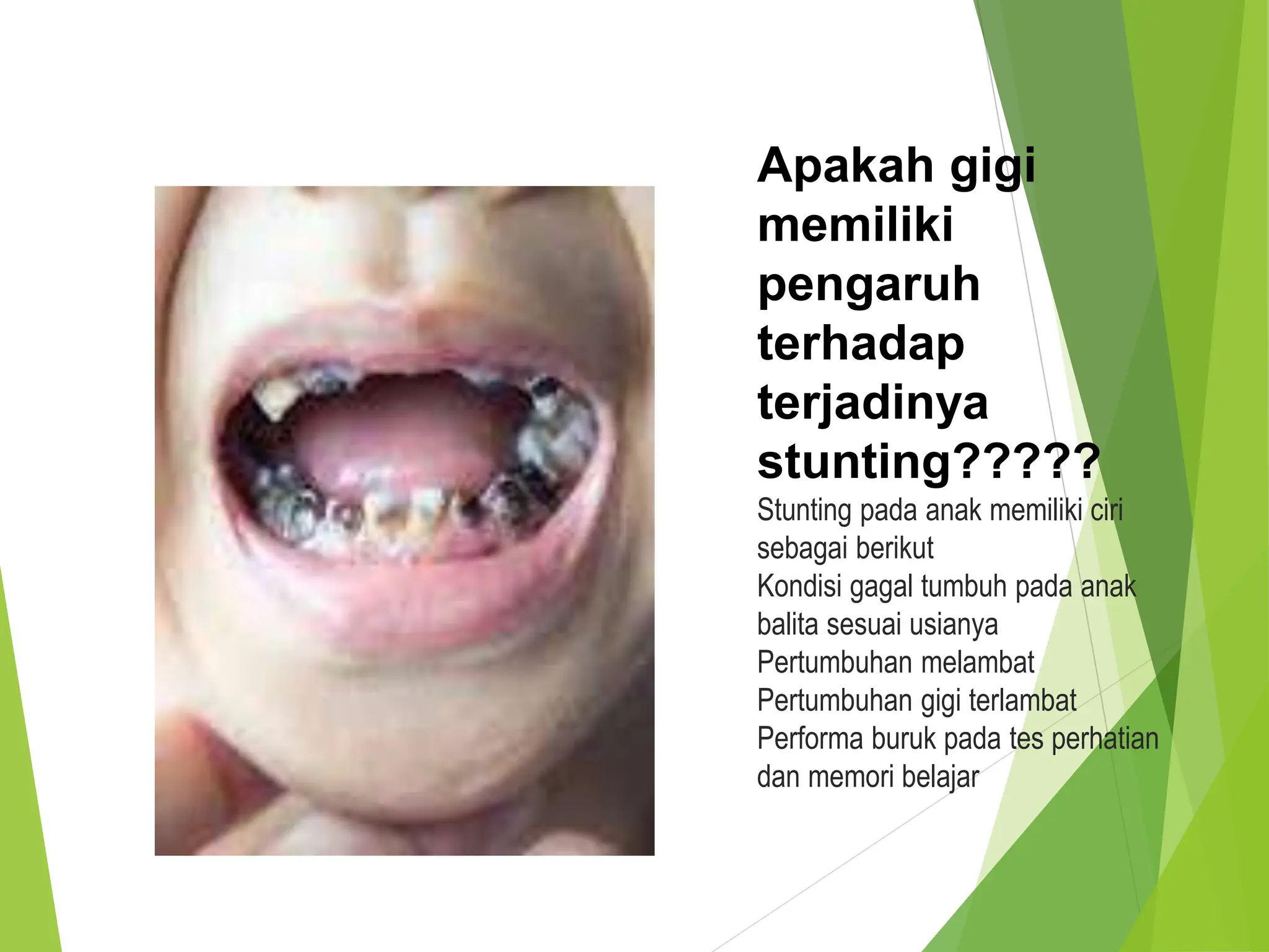 PPT MATERI karies gigi yang berhubungn dengan stunting.pptx