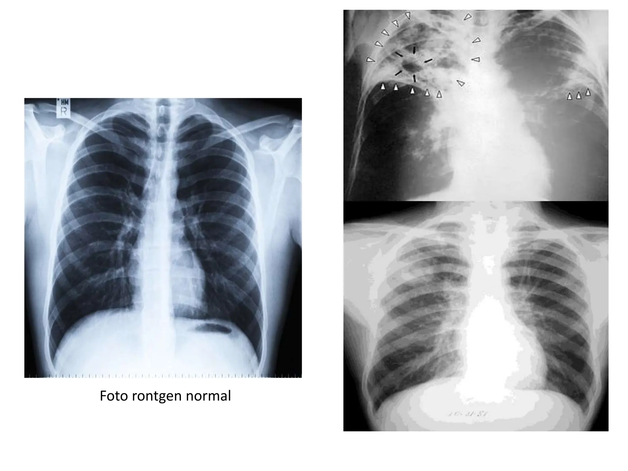 Ppt materi tuberculosis paru fixed. pptx | PPTX