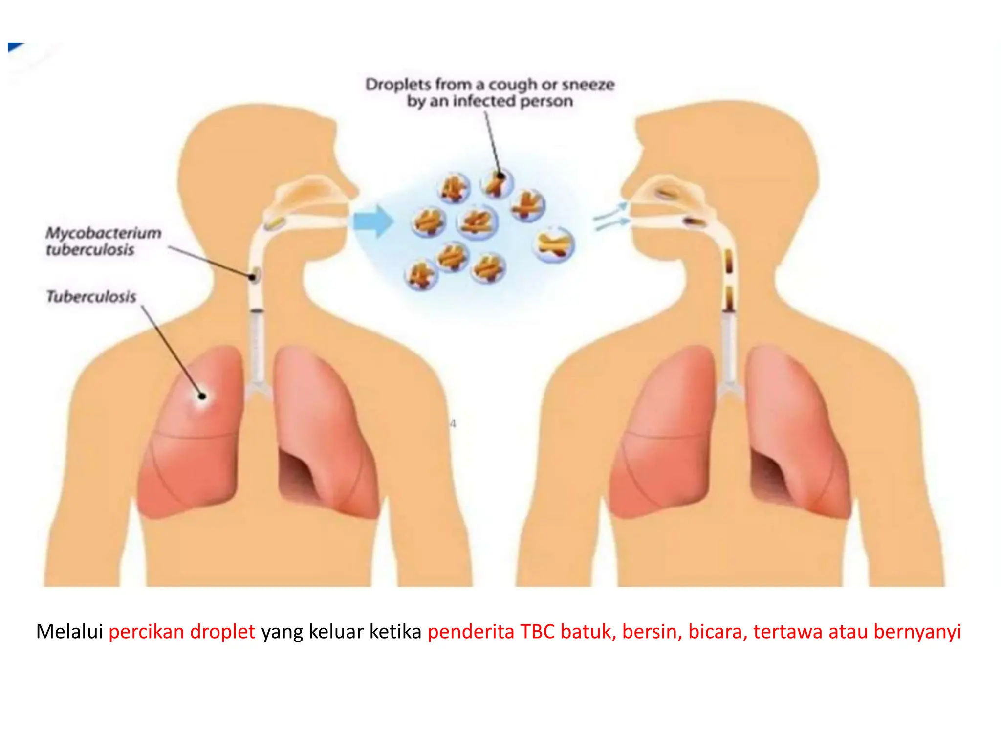 Ppt materi tuberculosis paru fixed. pptx | PPTX