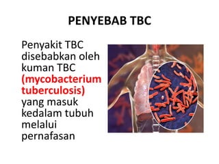 Ppt materi tuberculosis paru fixed. pptx | PPTX