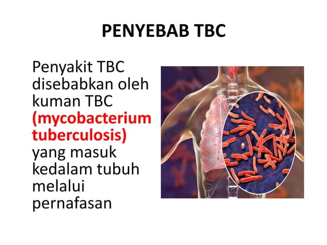 Ppt materi tuberculosis paru fixed. pptx | PPTX