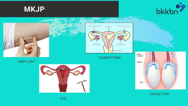 Metode kontrasepsi Jangka Panjang (MKJP) PPT | PDF