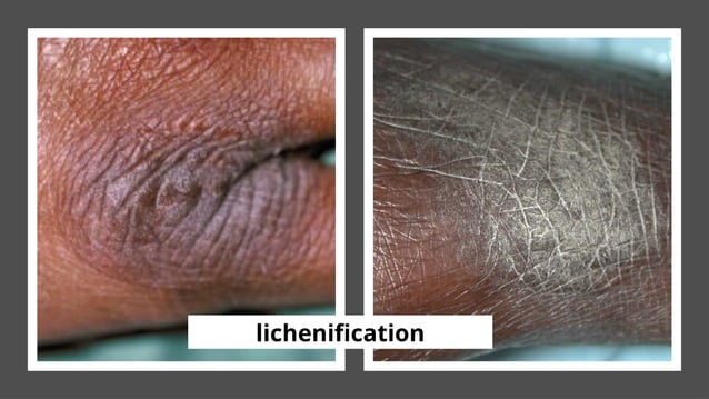 Clinical assessment in Dermatology ( Morphology ) | PPTX