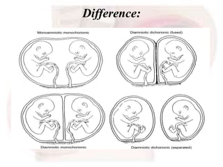 Ppt multiple pregnancy | PPTX