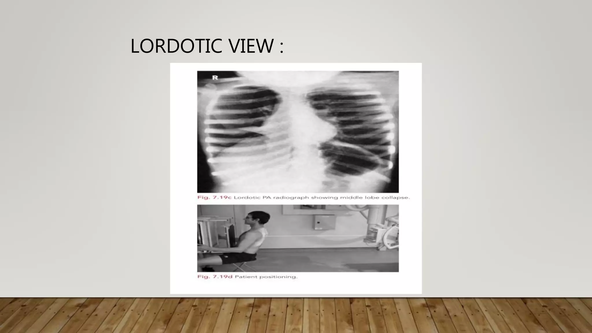 Normal chest X ray radiography interpretation | PPTX