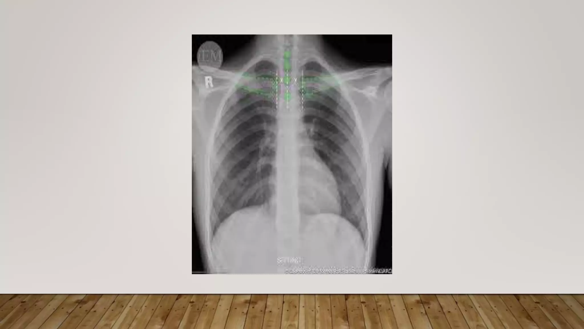 Normal chest X ray radiography interpretation | PPTX
