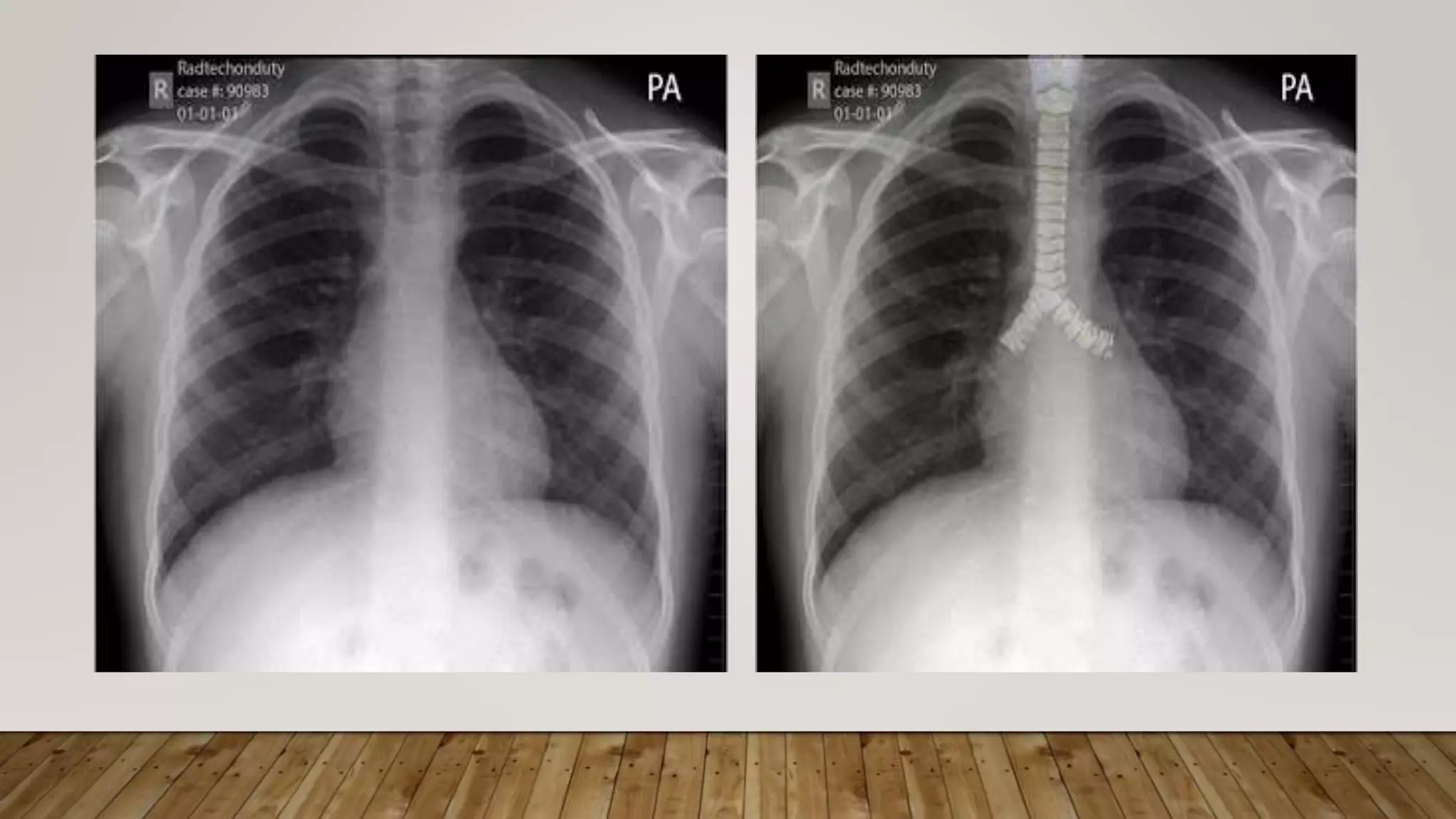 Normal chest X ray radiography interpretation | PPTX