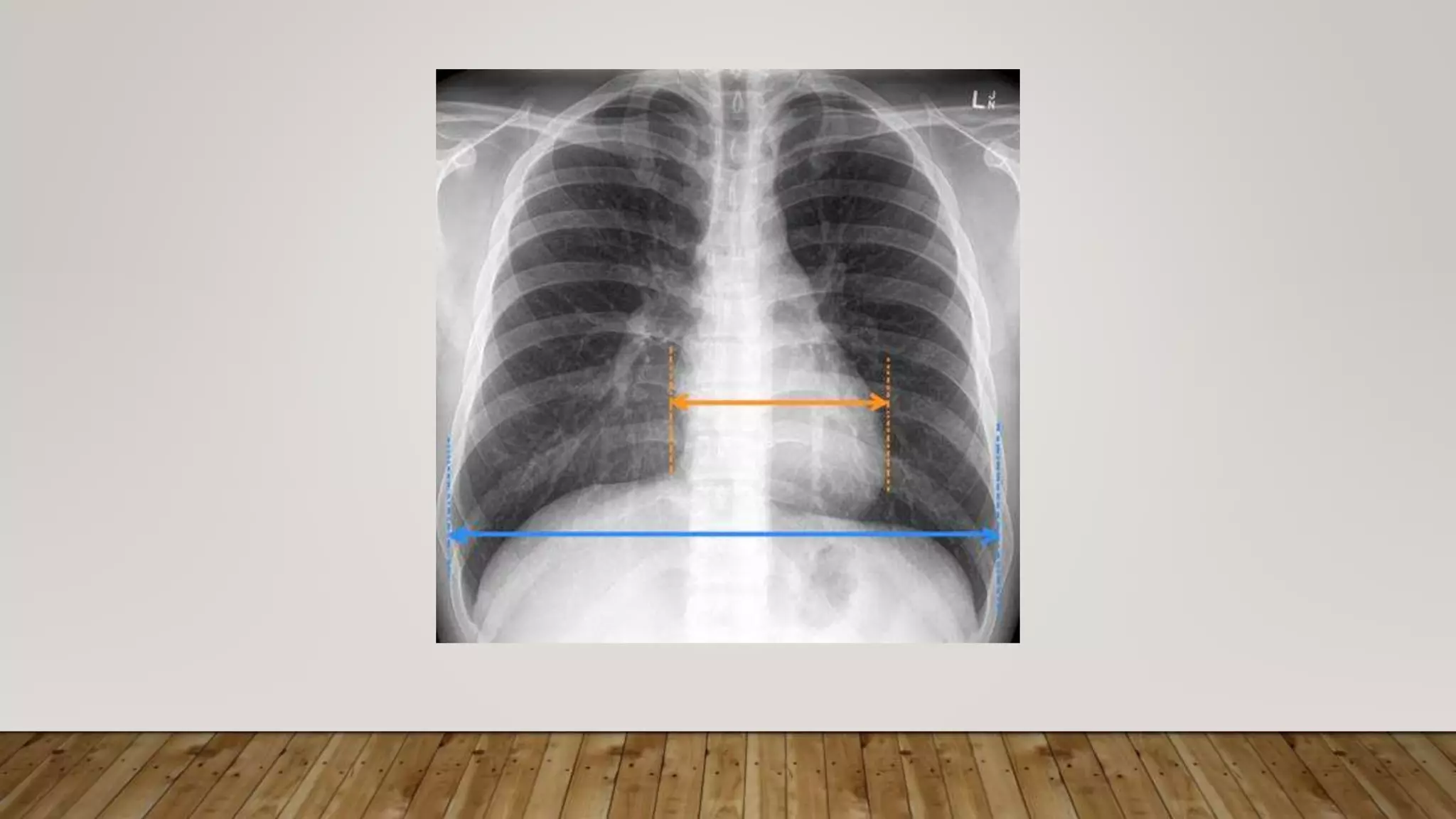 Normal chest X ray radiography interpretation | PPTX