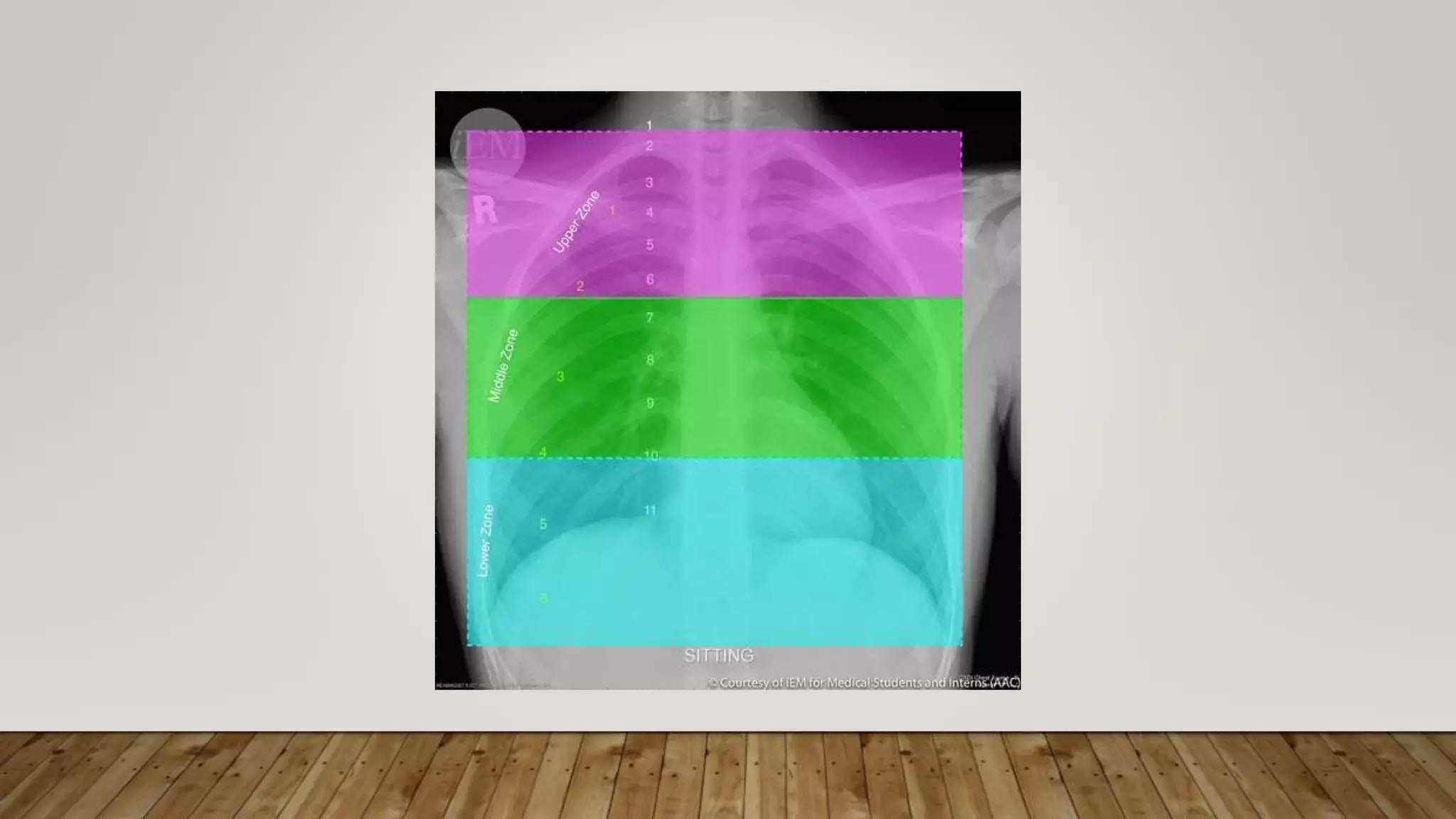 Normal chest X ray radiography interpretation | PPTX