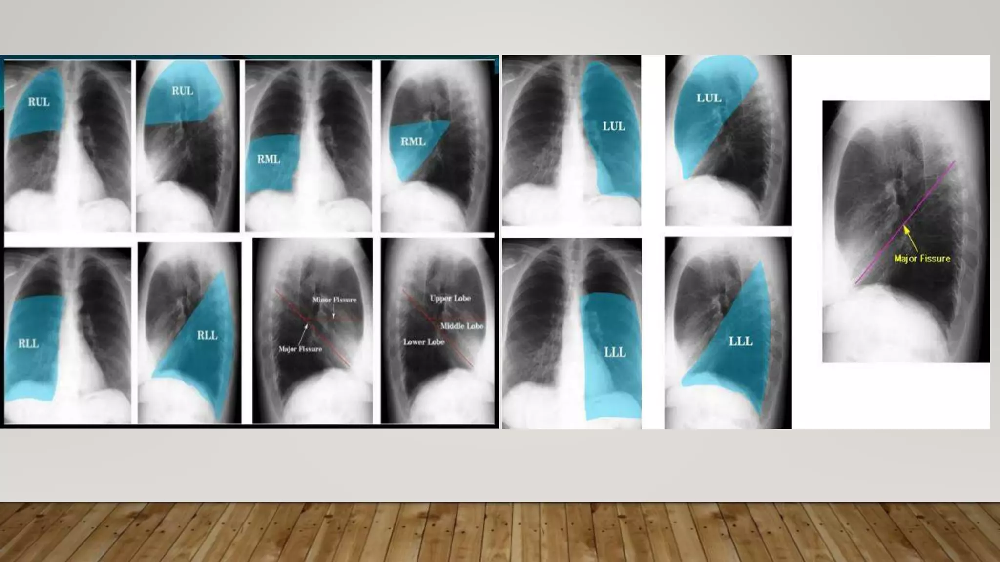 Normal chest X ray radiography interpretation | PPTX