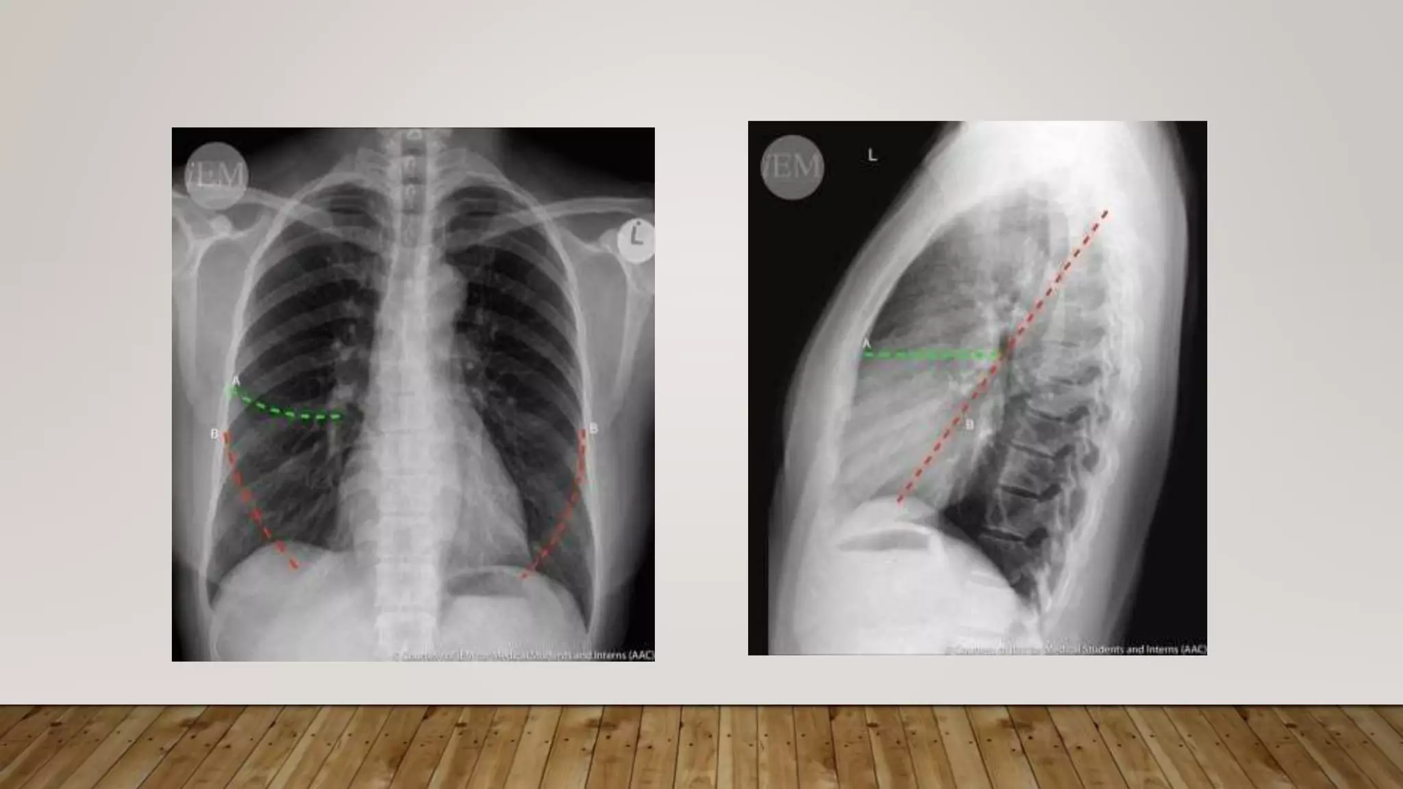 Normal chest X ray radiography interpretation | PPTX