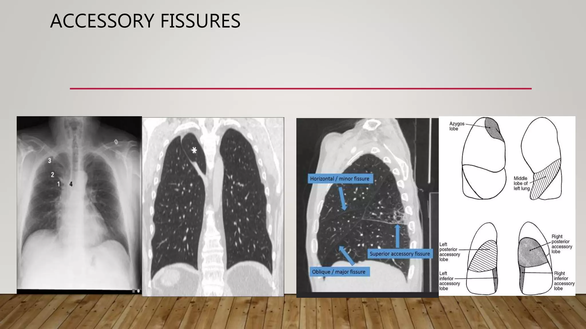 Normal chest X ray radiography interpretation | PPTX