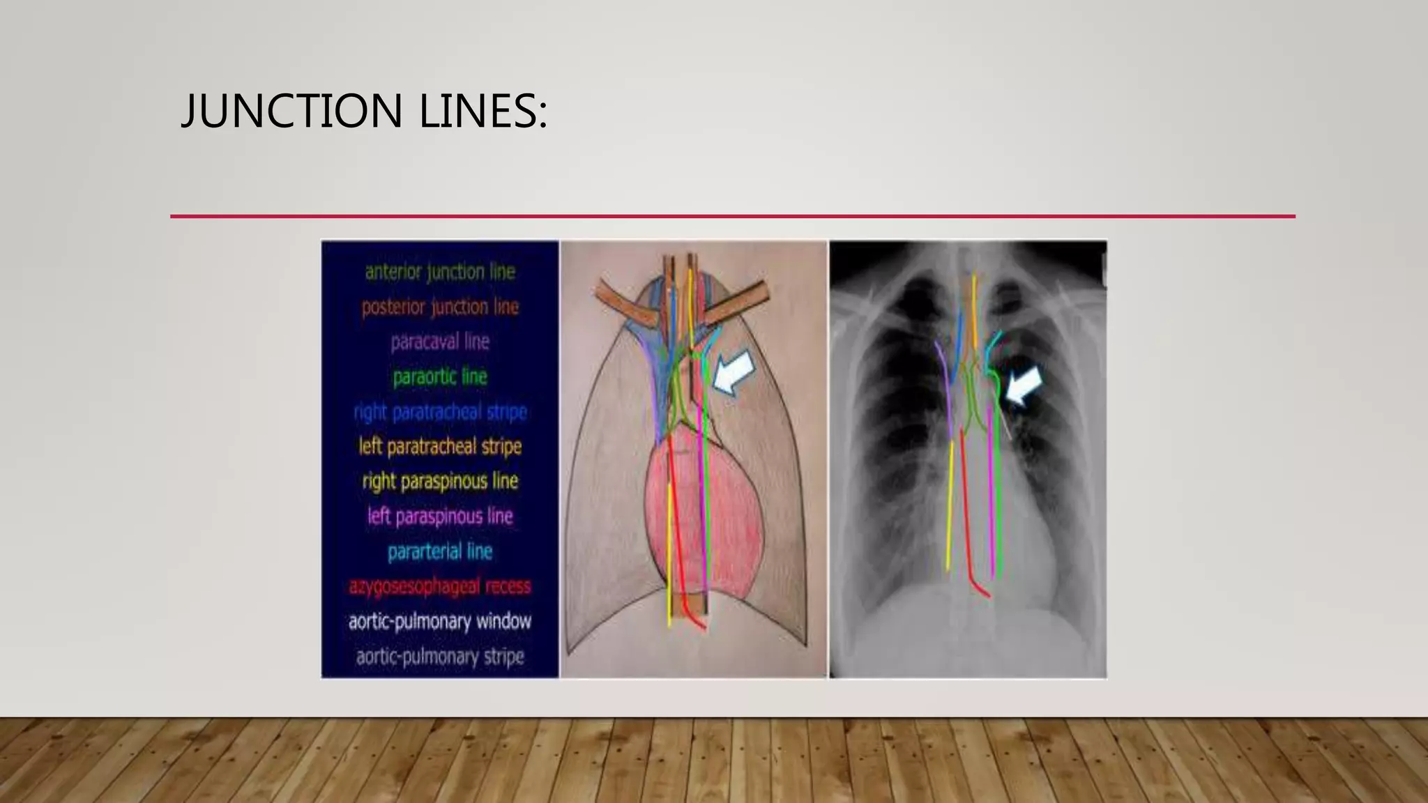 Normal chest X ray radiography interpretation | PPTX