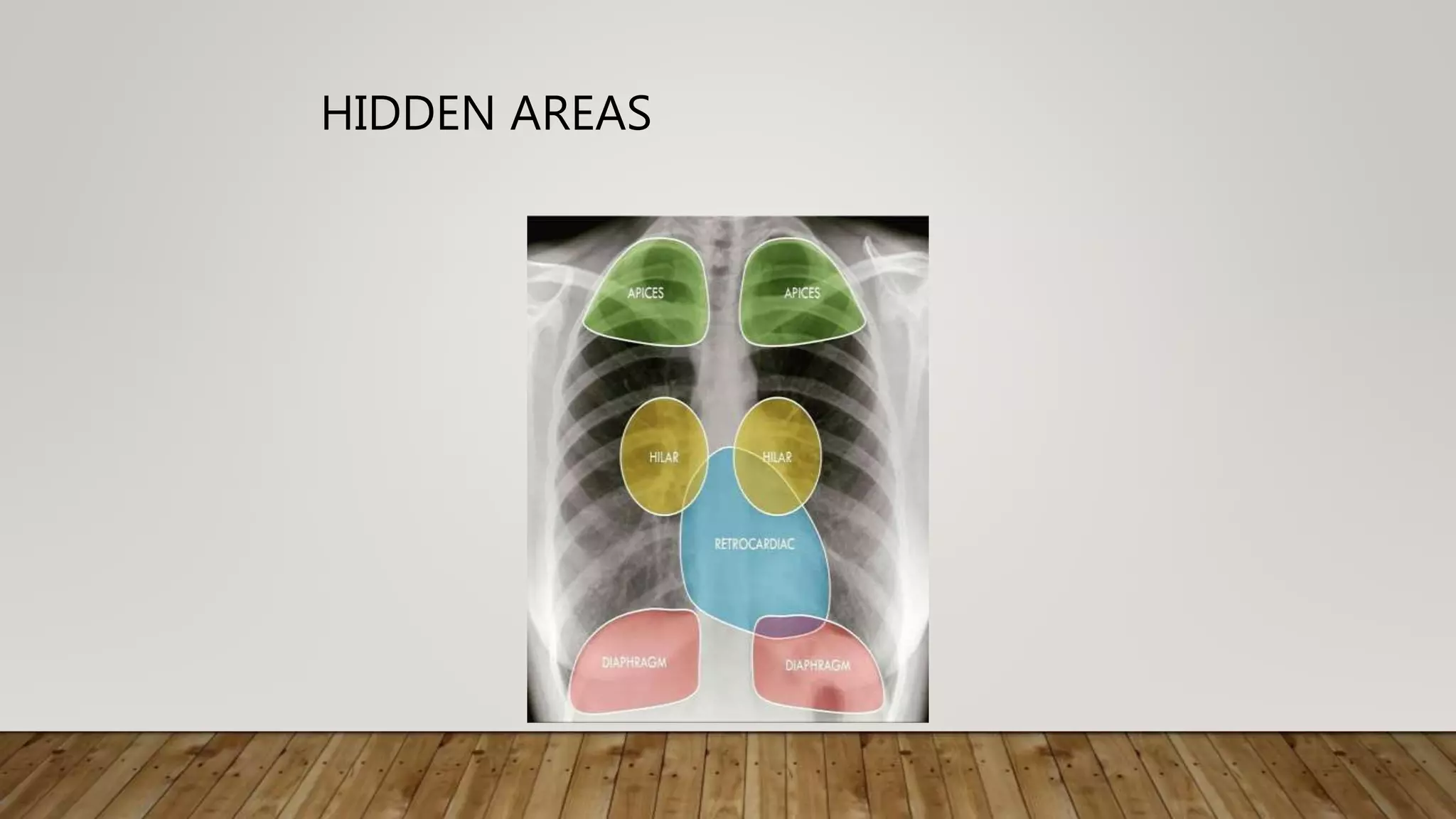 Normal chest X ray radiography interpretation | PPTX