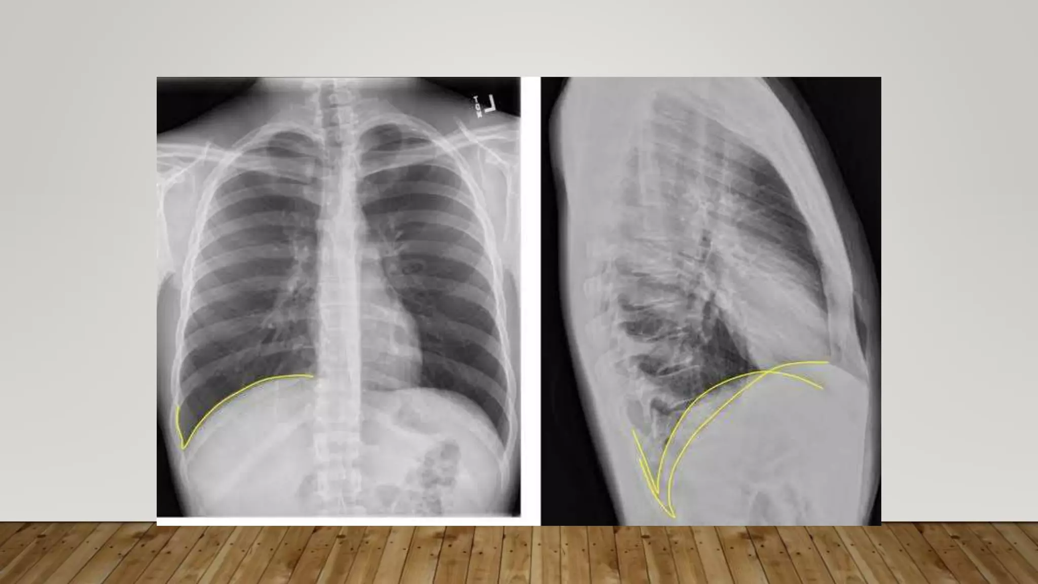 Normal chest X ray radiography interpretation | PPTX