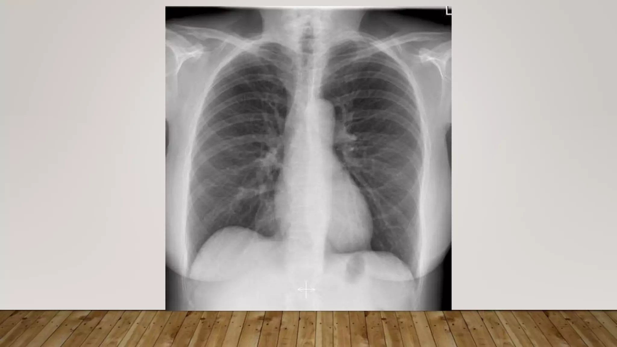 Normal chest X ray radiography interpretation | PPTX