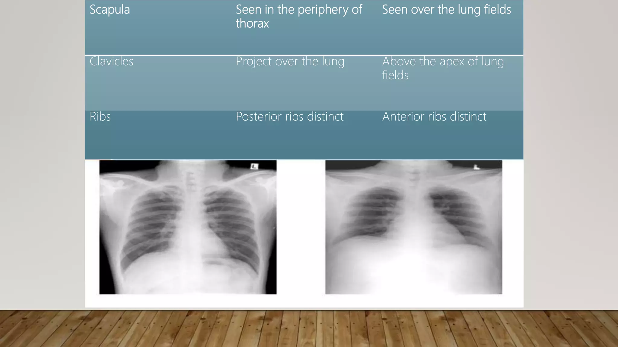 Normal chest X ray radiography interpretation | PPTX
