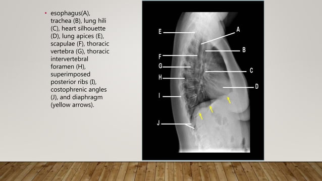 Normal chest X ray radiography interpretation | PPTX | Lung and ...