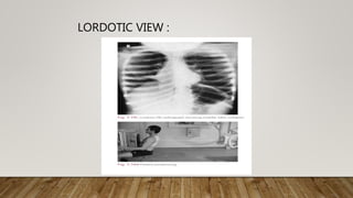 Normal chest X ray radiography interpretation | PPTX