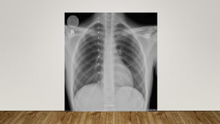 Normal chest X ray radiography interpretation | PPTX