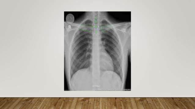 Normal chest X ray radiography interpretation | PPTX | Lung and ...