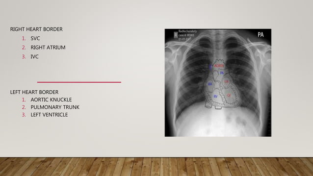 Normal chest X ray radiography interpretation | PPTX | Lung and ...