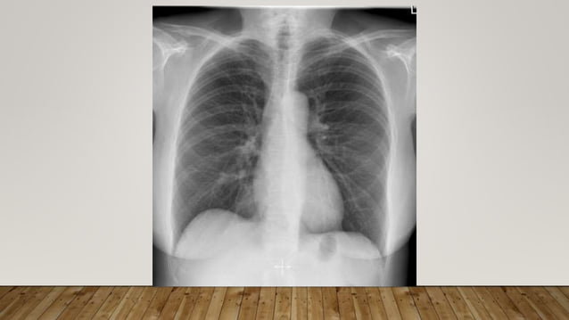Normal chest X ray radiography interpretation | PPTX | Lung and ...