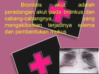 Ppt nura bronkhitis | PPT