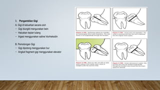 PPT Odon - Nabilah Putri - odontektomi.pptx