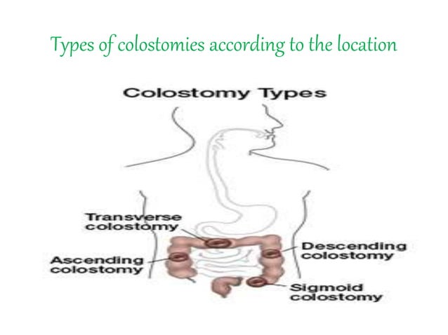 Ppt of colostomy | PPTX | Digestive Disorders | Diseases and Conditions