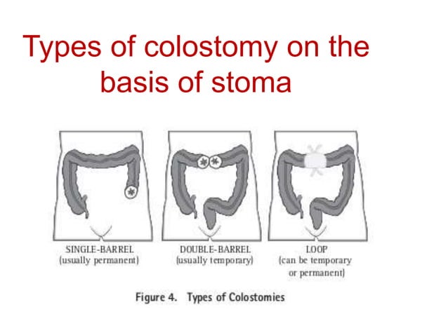 Ppt of colostomy | PPTX | Digestive Disorders | Diseases and Conditions