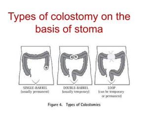 Double Barrel Colostomy