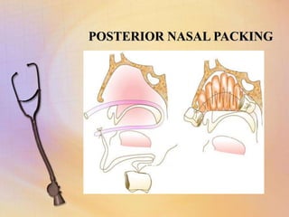 Ppt of epistaxis | PPT