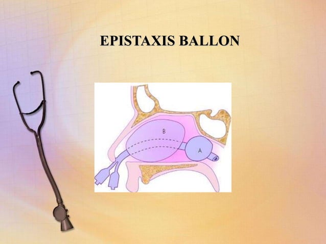 Ppt of epistaxis | PPT