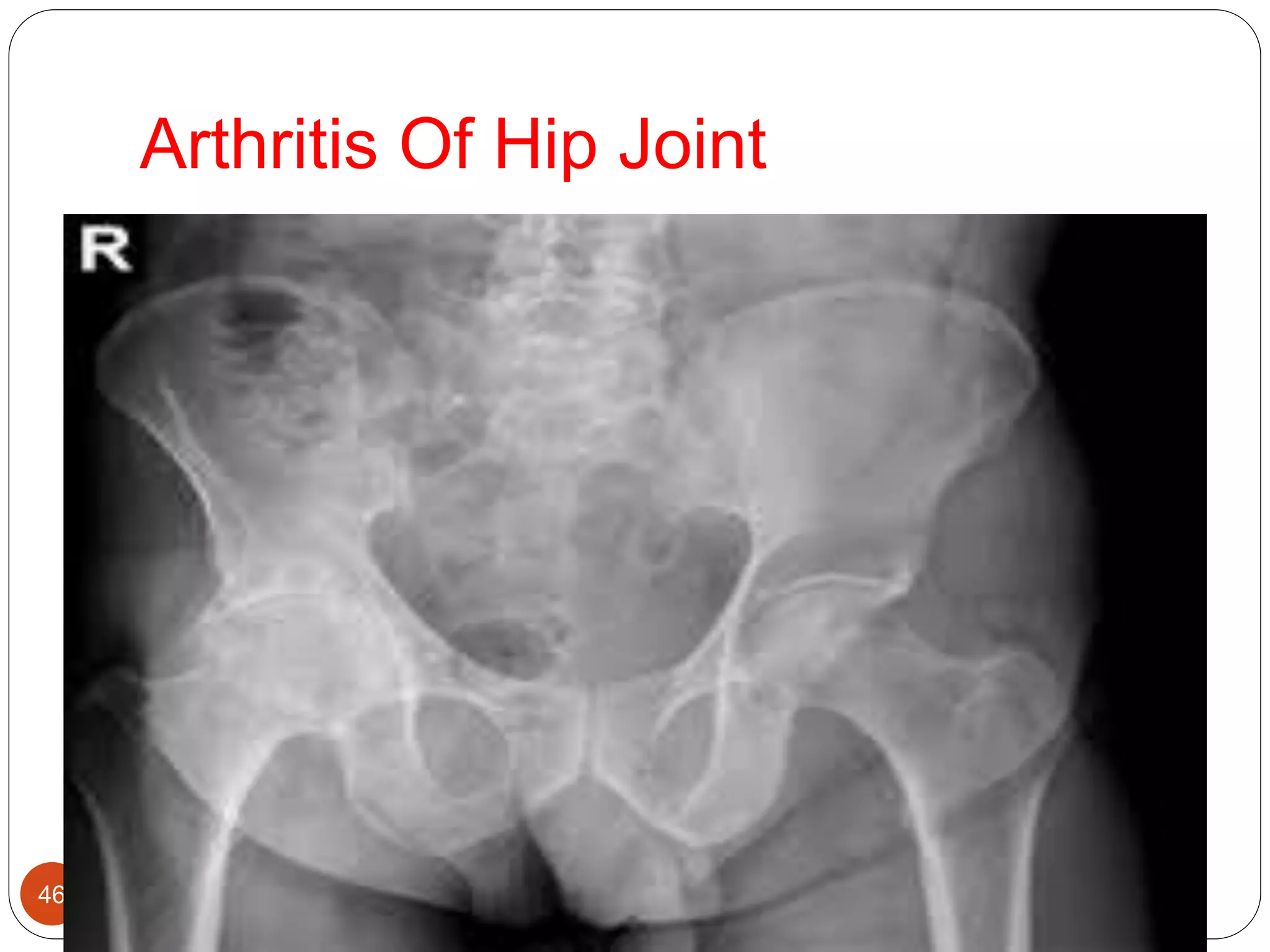 Applied Anatomy of Hip Joint | PPTX