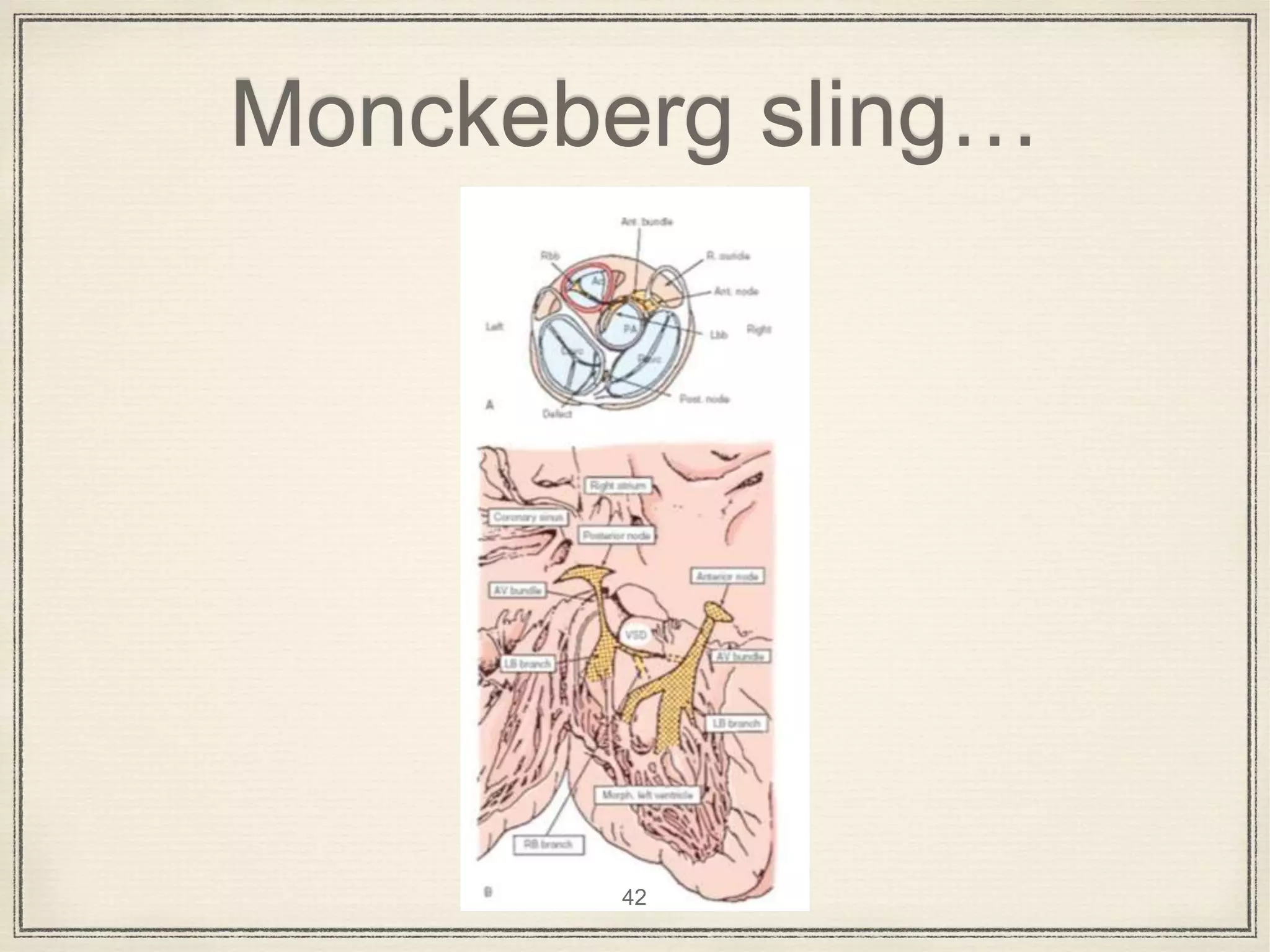 ARRHYTHMIAS AMENABLE TO RADIOFREQUENCY ABLATION IN CHILDREN | PPTX ...