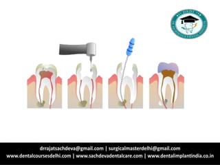 Re-root canal treatment| Root Canal Treatment| Advanced Root Canal ...
