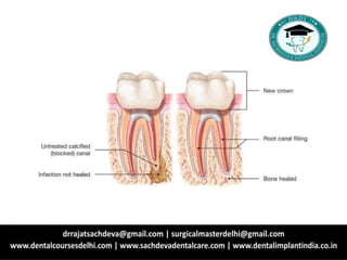 Re-root canal treatment| Root Canal Treatment| Advanced Root Canal ...