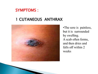 Ppt on anthrax and dengue fever | PPTX