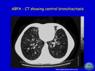 Powerpoint on aspergillosis | PPTX