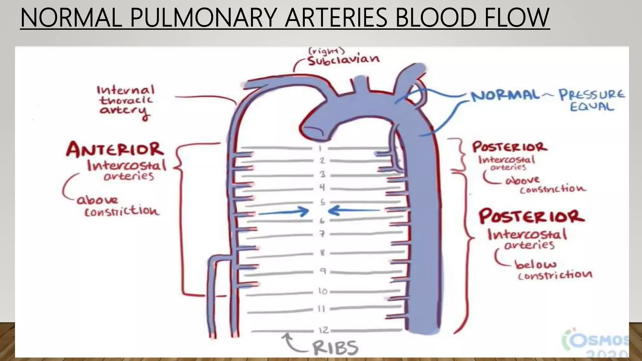 Coarctation of aorta |CONGENITAL HEART DEFECT | PPTX