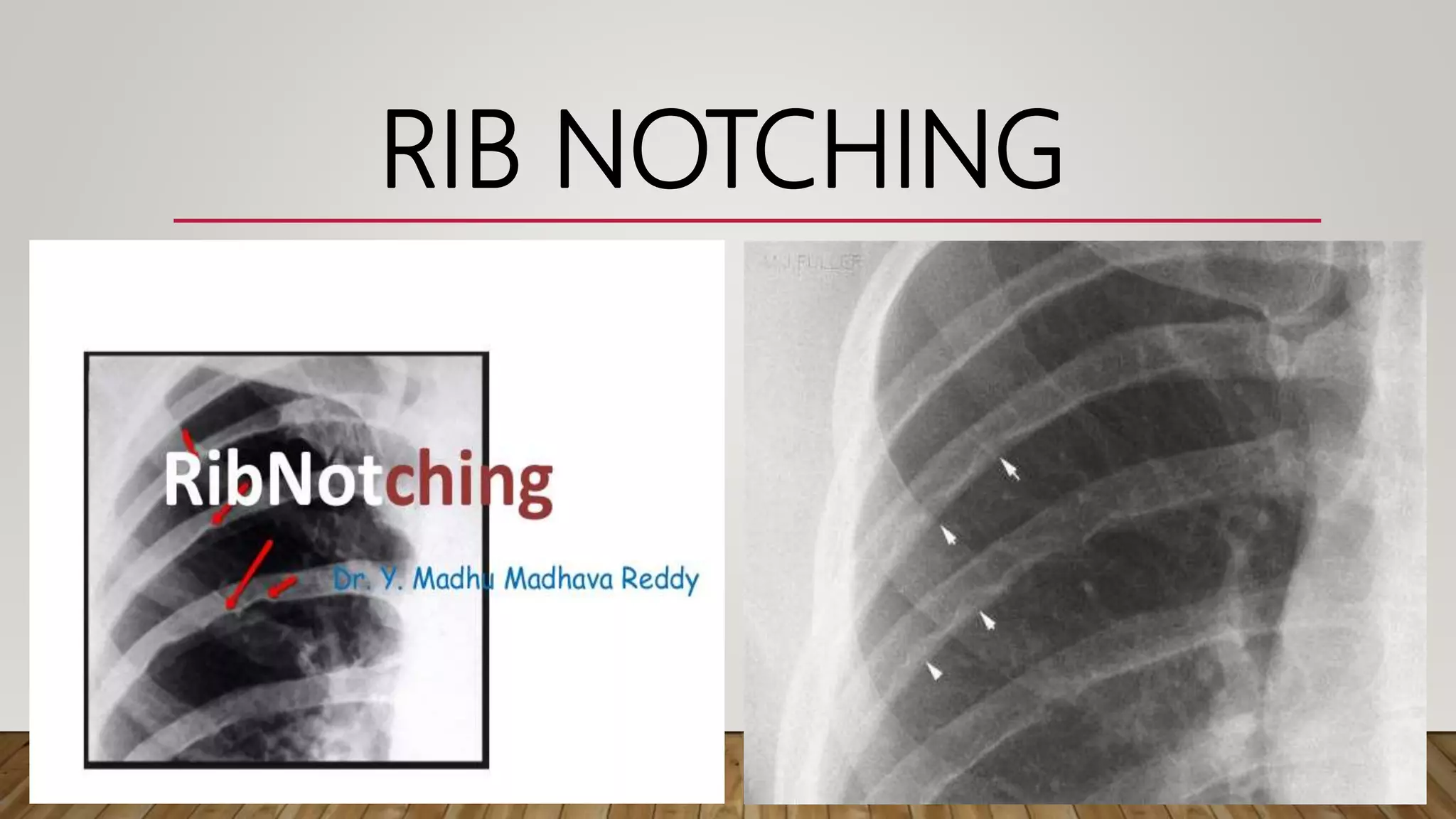 Coarctation of aorta |CONGENITAL HEART DEFECT | PPTX