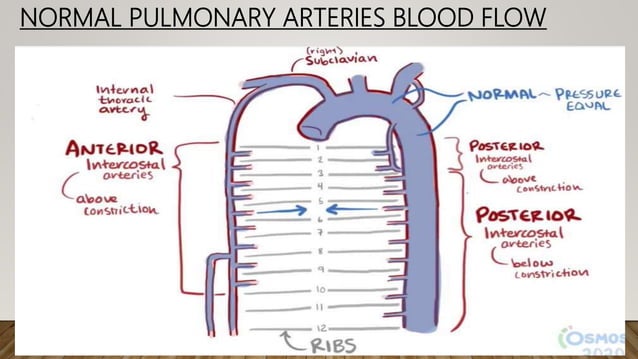 Coarctation of aorta |CONGENITAL HEART DEFECT | PPTX