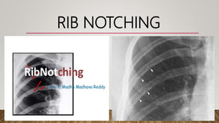 Coarctation of aorta |CONGENITAL HEART DEFECT | PPTX