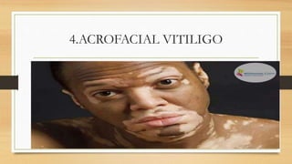 PPT ON LEUCODERMA.pptx