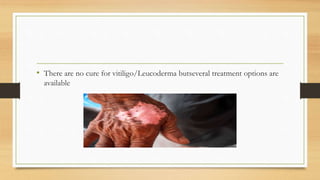 PPT ON LEUCODERMA.pptx