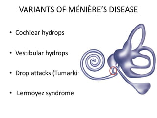 PPT on Meniere's disease: Definition, Pathology, Clinical features ...