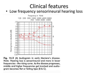PPT on Meniere's disease: Definition, Pathology, Clinical features ...